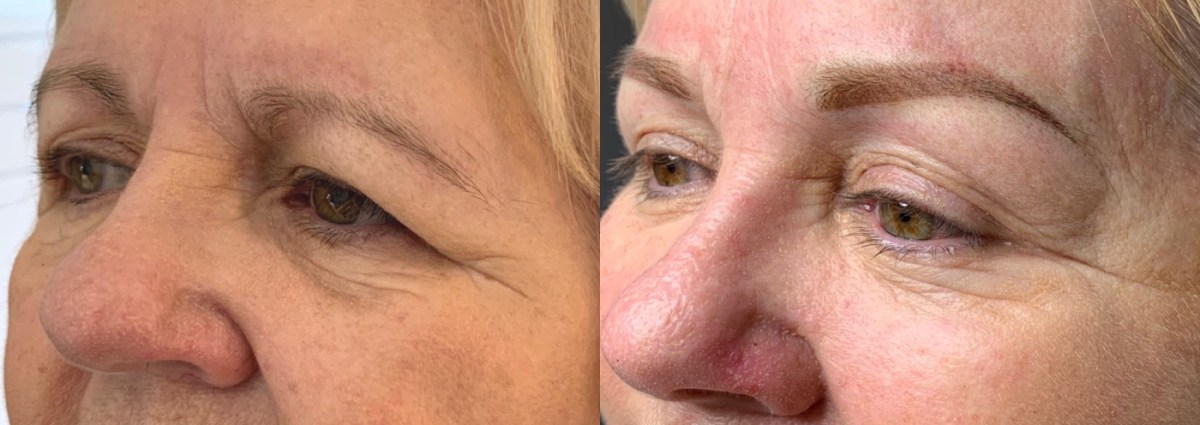 What is SPMU? – Linzi Hoare Brows (Company Number NI677747)